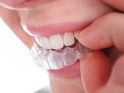 Tips for Relieving Invisalign Pain | Affiliated Orthodontics Peoria AZ